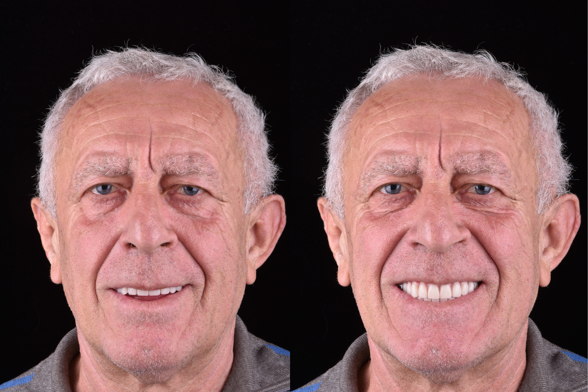All-on-6 implant placement and fixed prosthetics on a titanium bar ...